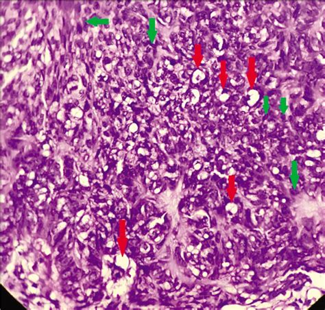 A Skin Colored Nodule On The Scalp Of A Woman Indian Journal Of Dermatology Venereology And