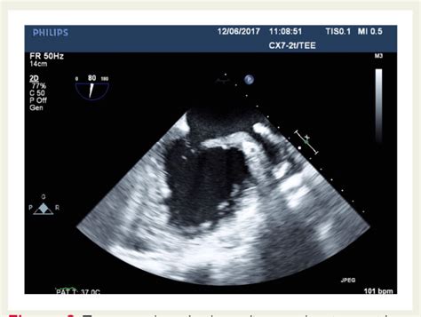 Figure 3 From A Case Report Of Primary Cardiac Intimal Sarcoma Presenting With Atrial
