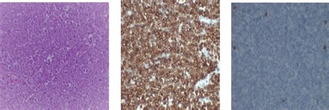 Immunophenotypic Characterisation Of Non Hodgkin Lymphomas At A Tertiary Hospital In Ghana Ecancer