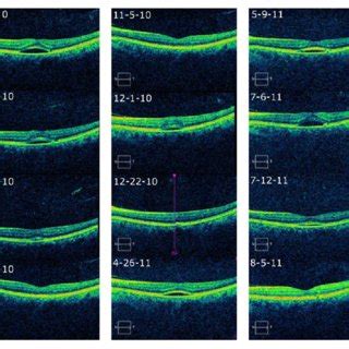 CSCR Of The Left Eye At Initial Visit And 6 Year Follow Up OCT Scans Download Scientific
