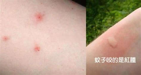 跳蚤和蚊子叮咬的区别，你知道吗？