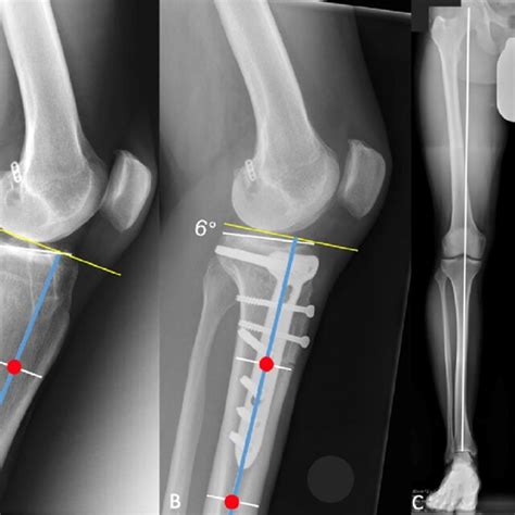 Increased Posterior Tibial Slope Pts Measured On Lateral Radiograph Download Scientific