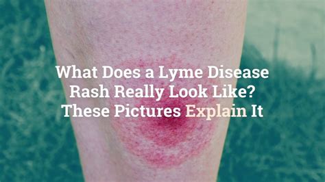 Lyme Disease Rash When Does It Appear At Kraig Hess Blog