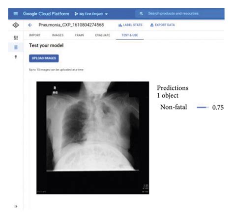 Deep Learning Models To Predict Fatal Pneumonia Using Chest X‐ray Images Anai 2022
