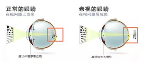 老花眼手术全解：整理老花眼33个问题和答案，快来看！ 晶睛网