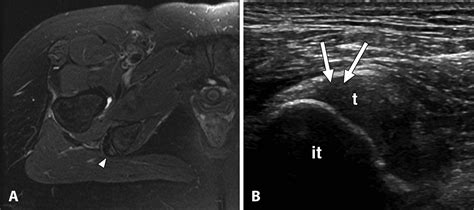 Hamstring Ultrasound Protocol At Jenenge Blog