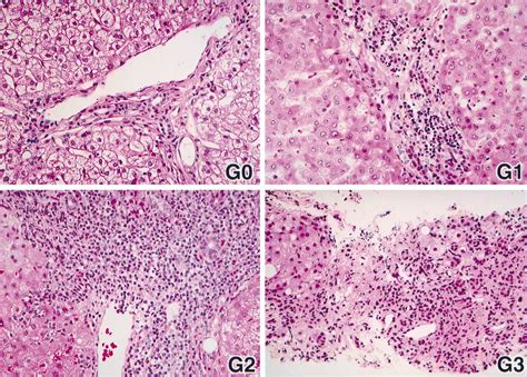 Figure 1 From Predicting The Liver Histology In Chronic Hepatitis C How Good Is The Clinician