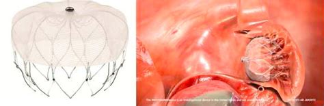 Percutaneous Closure Of The Left Atrial Appendage For Prevention Of Thromboembolism In Atrial
