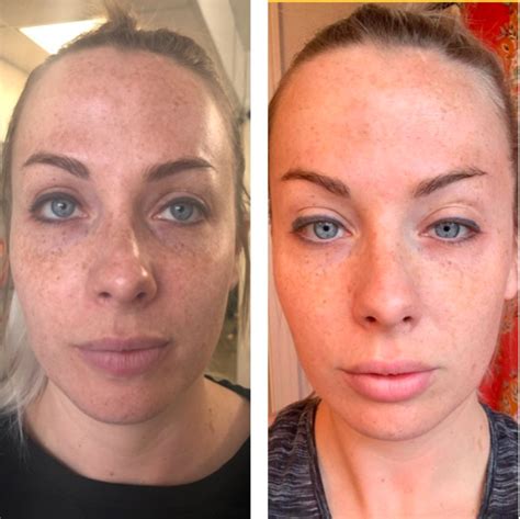 Microneedling Face Before And After Wekyvm