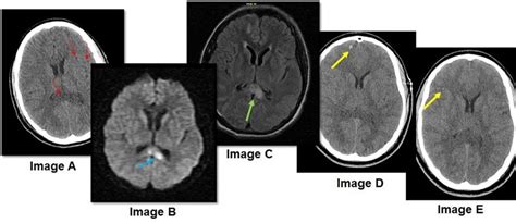 Diffuse Axonal Injury DAI Image A Axial CT Image With No IVC Download Scientific Diagram