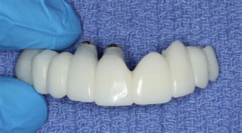 Upper Fixed Implant Bridges Immediate Fixed Temporary Bridge