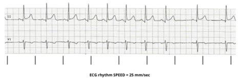 227314 Anaesthesia Ecg Id Flashcards Quizlet