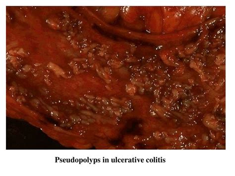 Ppt Pathogenesis Of Diseases Of The Large Intestine Powerpoint