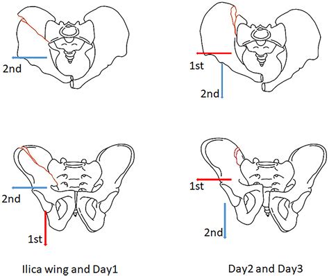 Types Of Pelvis