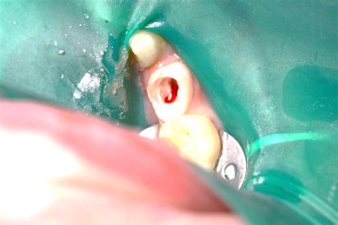 Perform A Mta Pulpotomy