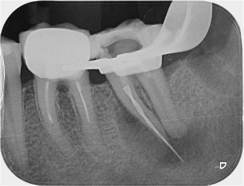 Root Canal Treatment Gallery Before And After Photos London Dentist