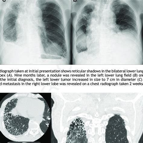 Computed Tomography Of The Chest Shows Bilateral Honeycombing With Download Scientific Diagram