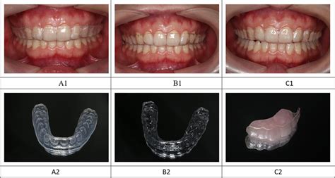 Three Different Splints A1 A2 Soft Occlusal Splint B1 B2 Hard Download Scientific Diagram