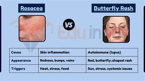 Difference Between Rosacea And Butterfly Rash