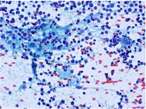 Fna Cytology Showing Follicular Cells Polymorphic Lymphocytes Download Scientific Diagram