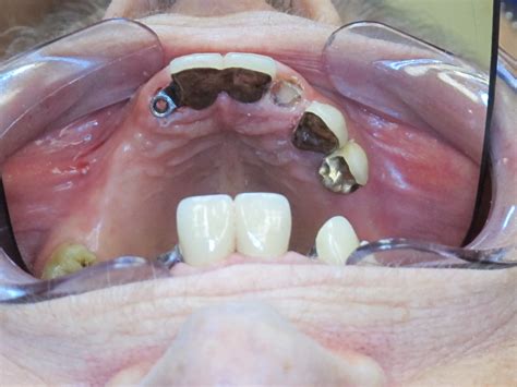 Precision Attachment Partial Dentures Dr Andrew Willoughby