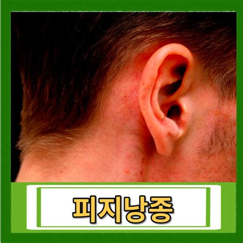 귓볼 몽우리 귀뒤 피지낭종 표피낭종 여드름 염증 부음 고름 통증 병원 치료 체크해요 네이버 블로그