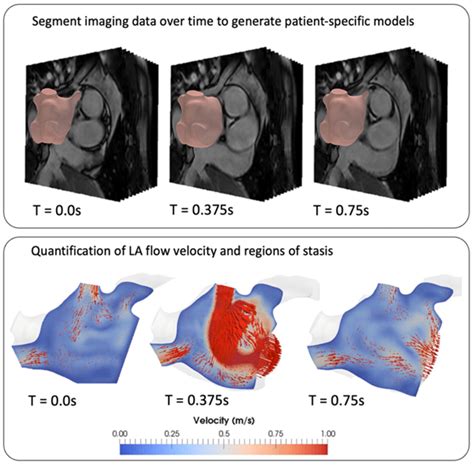 Image Based Stratification And Therapy Selection For Atrial Fibrillation Patients Using Deep