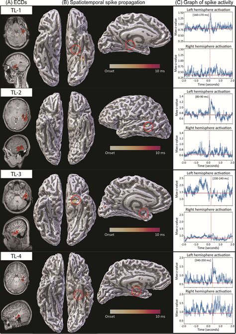 Temporal Lobe Tl Propagation Group Each Row Shows Results For Each Download Scientific