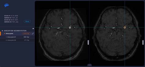 Automatic And Precise Aneurysm Detection