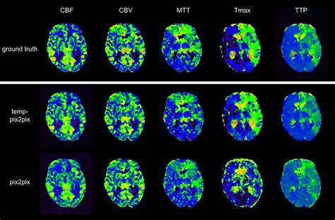 Synthesized Perfusion Parameter Maps Middle And Bottom Row Compared
