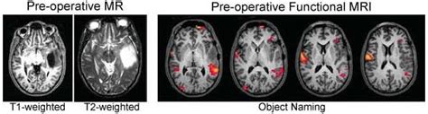 Fmri Golby Lab