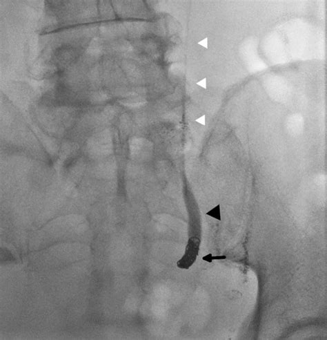 Transrenal Ureter Embolization For Refractory Urine Leaks From