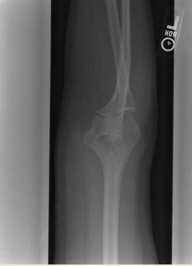 Olecranon Fracture Wikidoc