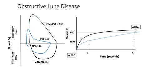 Spirometry Obstructive Pattern Hot Sex Picture