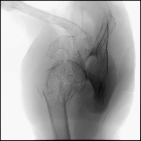 Preview Fracture Of Proximal Humerus Left
