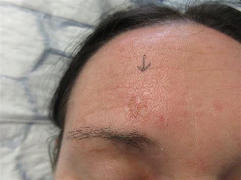 Basal Cell Carcinoma Pictures Visual Bcc Examples By Mr Tehrani