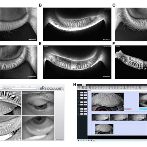 Meibomian Gland Morphology Ocular Surface Interferometer Lipiview Ii