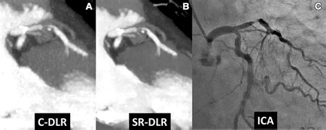 Super Resolution Deep Learning Reconstruction For Improved Image