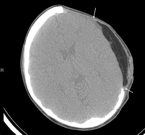 Patient Requiring Large Dural Repair For Cerebrospinal Fluid Leak Download Scientific Diagram