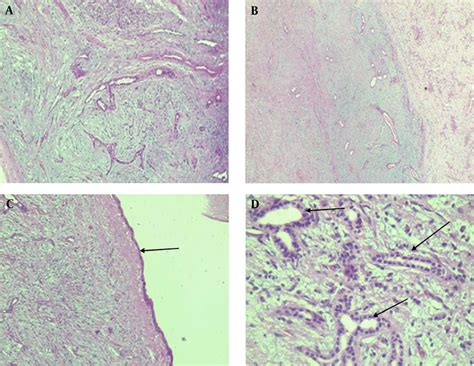 A Histology Shows Epithelial Component And B Myxoid Stroma C Cystic Download Scientific