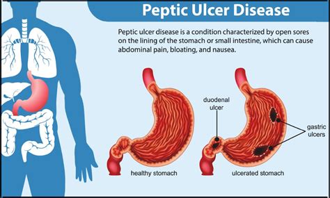 Gastric Ulcer Vs Duodenal Ulcer Stomach In Situ