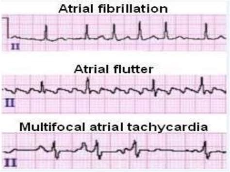 Atrial Fib And Flutter