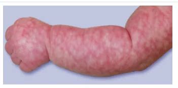 Pediatric Dermatology Basics And Transient Phenomena Prepladder