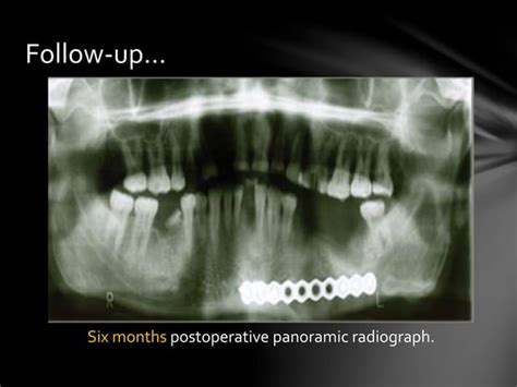Chronic Osteomyelitis Of The Mandible Case Report Pptx