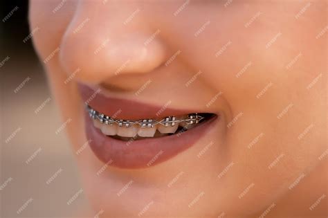 Premium Photo Closeup Smile With Braces Smiling Girl Closeup Smile