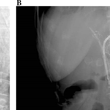 A Bilateral Side By Side Stent Placement A Cholangiography Revealed Download Scientific