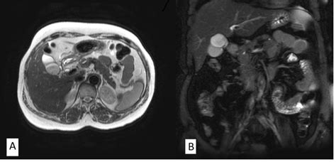 Bilobed Gallbladder A Rare Congenital Anomaly Bmj Case Reports