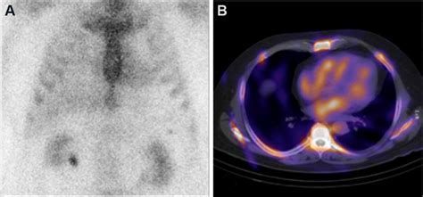 Technetium 99m Pyrophosphate Bone Scan A Mild Tracer Uptake That Download Scientific Diagram