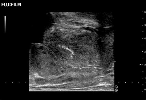 Intraoperative Ultrasound For Urology Fujifilm Healthcare
