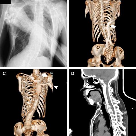 Figure A Preoperative X Ray Image B D Computed Tomography Images Download Scientific